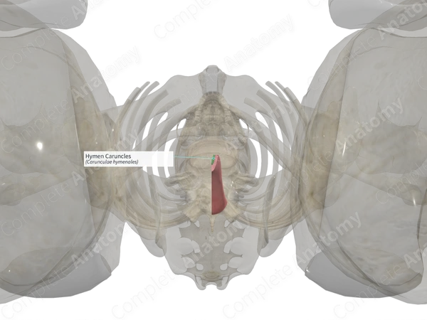 Hymen Caruncles (Right) | Complete Anatomy