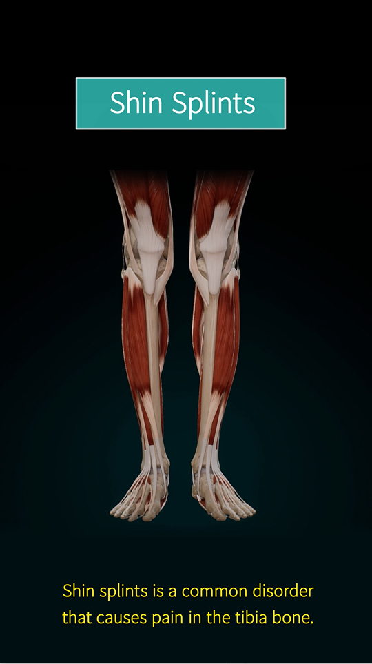 Understanding SHIN SPLINTS And How To Fix 57 OFF